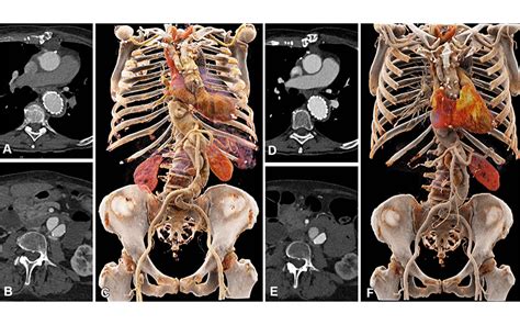 Photon Counting Ct Angiography Rsna Photon Counting Ct Angiography Rsna