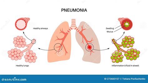 Pneumonia Infection Poster Cartoon Vector 274105569
