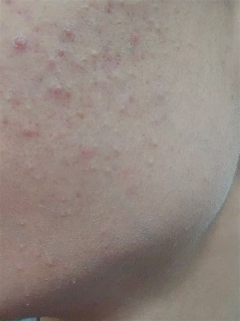 여드름 없애는법 지식in