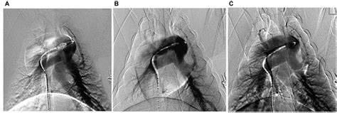 A Dsa Image Taken 15 Min After Embolisation Of The Right Pulmonary