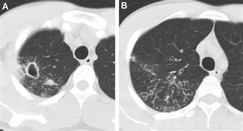 Cavitary Lung Diseases Chest