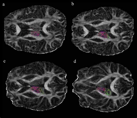 Figure 79 From Segmentation Of Diffusion Weighted Mri Using The Level Set Framework Semantic