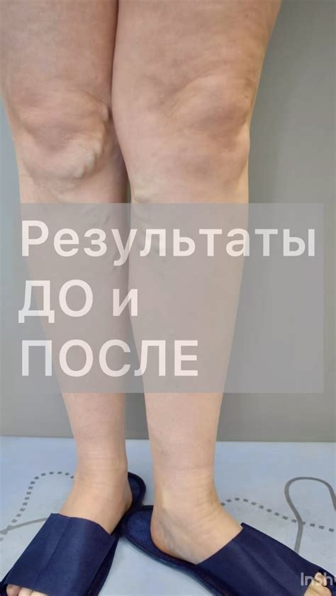 Venoclinica Рубрика страхи пациентов Рассказ про «удаление вены Врач флеболог Кочетков