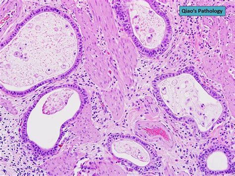 Adenomyomatosis Of Gallbladder Histology Oijxja