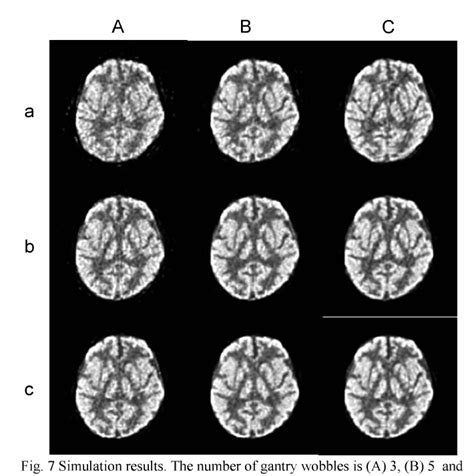 Figure 7 From Development Of A Multi Pinhole Brain Spect System With Cdznte Semiconductor