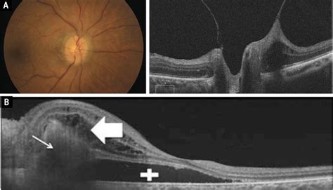 Navigating Optic Nerve Differentials