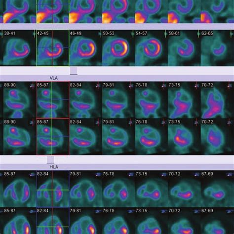 A Spect Myocardial Perfusion Vla Images Showing Diffuse Hypoperfusion