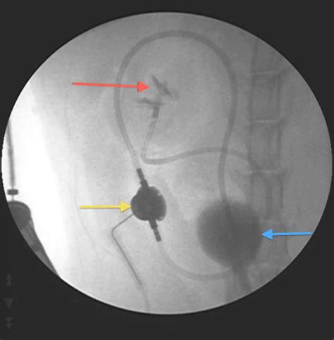 Subcutaneous Ureteric Bypass News Eastcott Referral