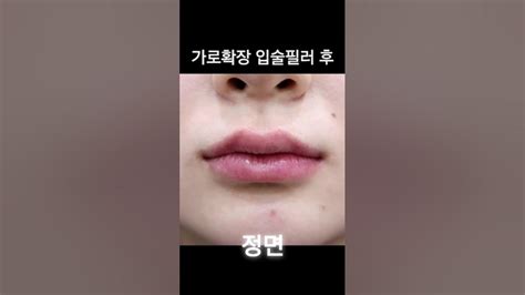입술필러 고민하는 분들에게 디자인 시술로 내 입술을 완성해 보세요 Youtube