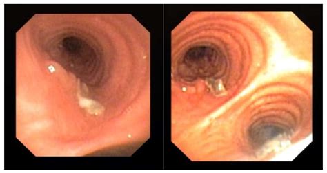 Bronchoscopy Pneumonia