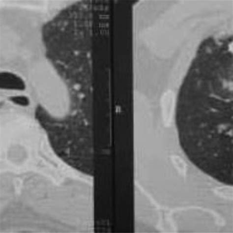 Catheter Angiography Image Showing The Pruned Tree Appearance Of The