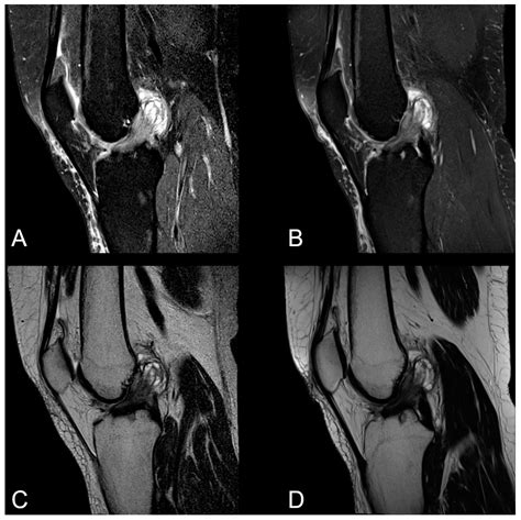 Diagnostic Image Quality Of A Low Field 0 55t Knee Mri Protocol Using Deep Learning Image
