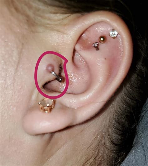 Hypertrophic Scar Treatment Piercing Pregnancy Depression
