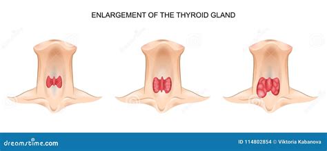 Enlargement Of The Thyroid Gland Stock Vector Illustration Of Gland Body 114802854