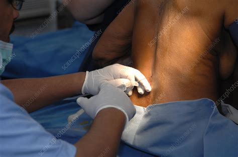 Epidural Stock Image C Science Photo Library