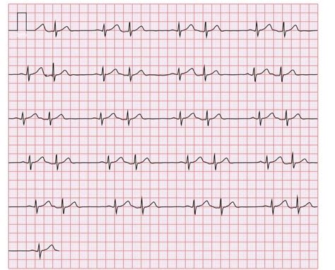 Pattern Before Afib Rreadmyecg