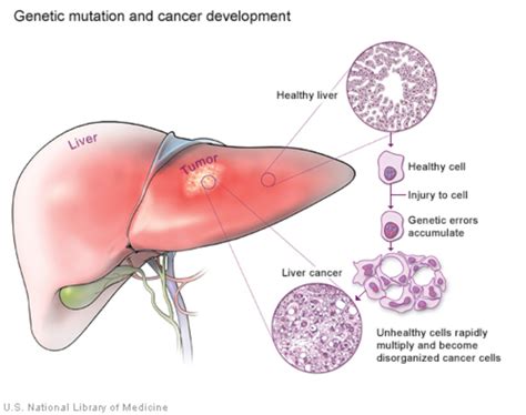 Cholangiocarcinoma Medlineplus Genetics