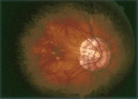 Polypoidal Choroidal Vasculopathy Pcv North America American