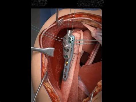 Proximal Humerus Fracture ORIF Through The Deltopectoral Approach Humerus Fracture
