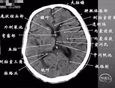 【推荐】颅脑 Ct 解剖详解 脑医汇