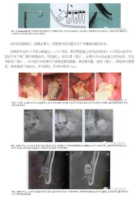 第三磨牙 前磨牙 第三磨牙图片 第2页 大山谷图库