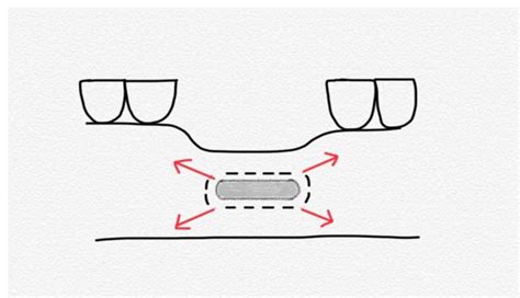 G Autonomous Growth Of Tissue Expander