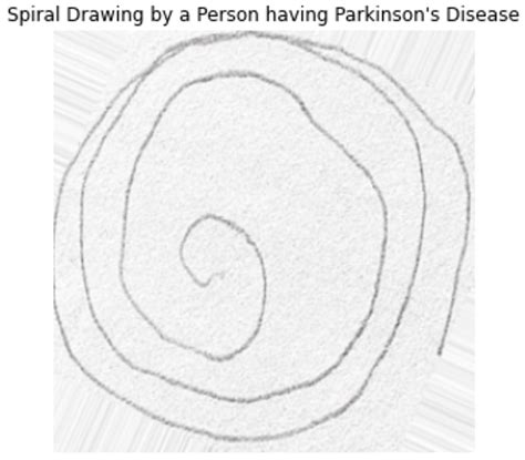 Parkinsons Disease Detection Using Spiral Drawings And Cnn