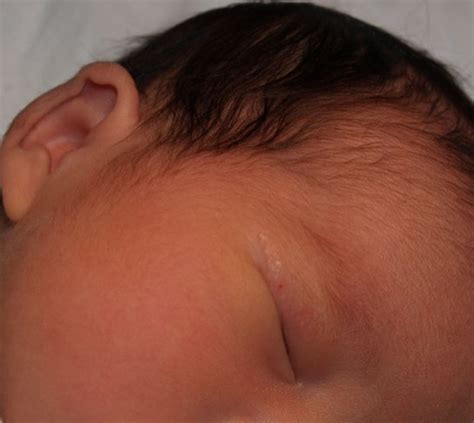 Epidermal Nevus Newborn