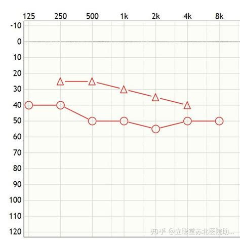听力损失分类 知乎