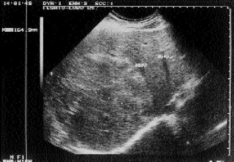 Cavernous Hemangioma Liver Ultrasound