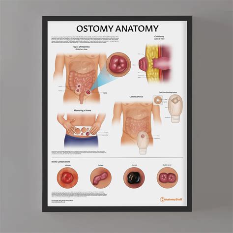 Ostomy Anatomy Poster Digestive And Urological Stoma Chart Anatomystuff Ostomy Anatomy Poster Digestive And Urological Stoma Chart Anatomystuff