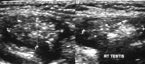 Ultrasonography Image Demonstrating Multiple Foci Of Calcifications Download Scientific Diagram