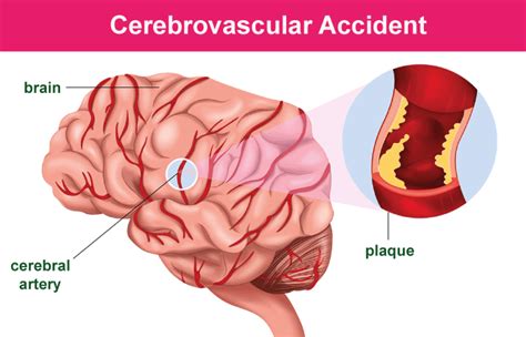 Cva Definition Tpoint Tech