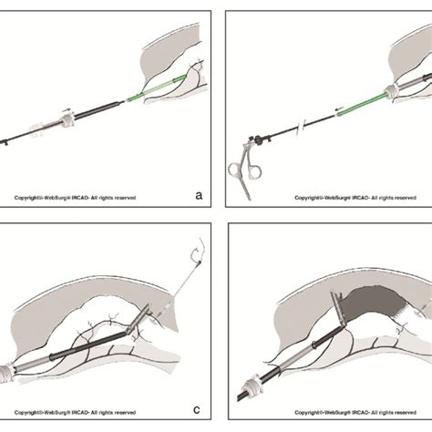 Segmental Colonic Resection A And B The Plastic Tube Serving As A Port Download Scientific