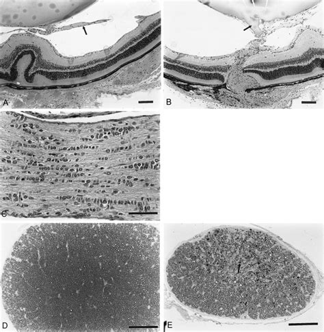 Photomicrographs Of Vitreal Neovascularization Retinal Dysplasia And Download Scientific