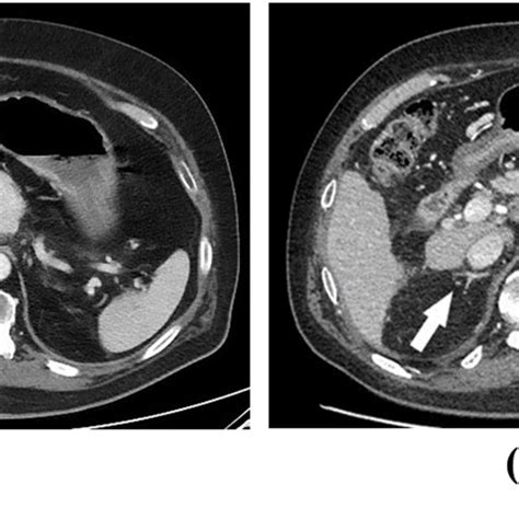 Computed Tomography Showing Mediastinal And Abdominal Lymph Node Download Scientific Diagram