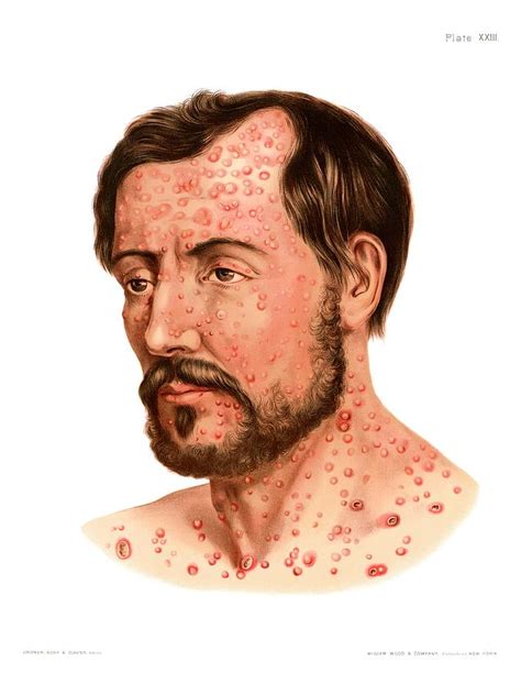 Secondary Syphilis Rash 6 Photograph By Science Photo Library Pixels