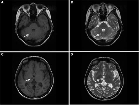 Brain Mri Ab T1 And T2 Sequences Showing Cerebral Infarction With A