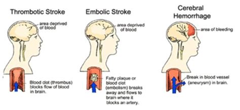 Differences Between Ischemic And Hemorrhagic Stroke Flashcards Quizlet