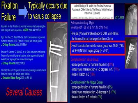 Fracture Proximal Humerus Fixation With K Wires And External Fixator Pptx