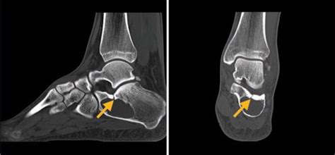 Unicameral Bone Cyst Calcaneus Surgery