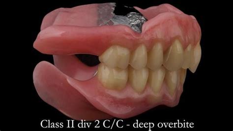 Complete Denture Class Ii Div 2 Deep Overbite Newsletter 39 Finlay