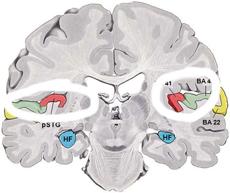 Tackling Tinnitus Understanding The Brains Role And Ear Seeds Benefits Ear Seeds Classes And