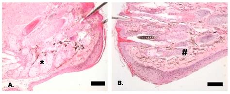 Extended Overview Of Ocular Phenotype With Recent Advances In Hypohidrotic Ectodermal Dysplasia