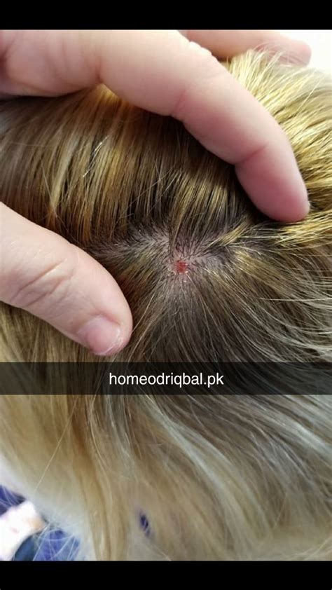 Scalp Folliculitis Hair Loss