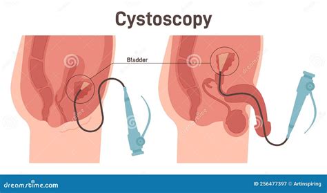 Cystoscopy Set Male And Female Bladder Surface Examination With A