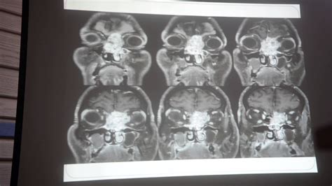 Medial Maxillectomy 2 Youtube