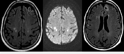 Non Contrast Mri 10 31 2022 Left Flair Mri Showing New Acute Areas Of Download Scientific