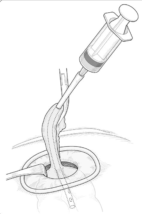 Decompression Of A Dilated Large Bowel The Mobilized Appendix Was