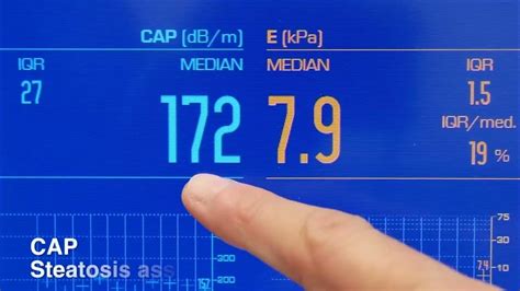 How To Do A Fibroscan Examination Tutorial Youtube